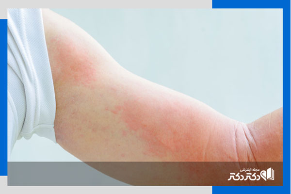 کهیر مزمن چیست؟ دکتردکتر