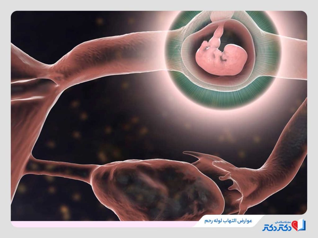عفونت لوله رحم یا سالپنزیت چیست؟ + علائم، علل، عوارض و درمان