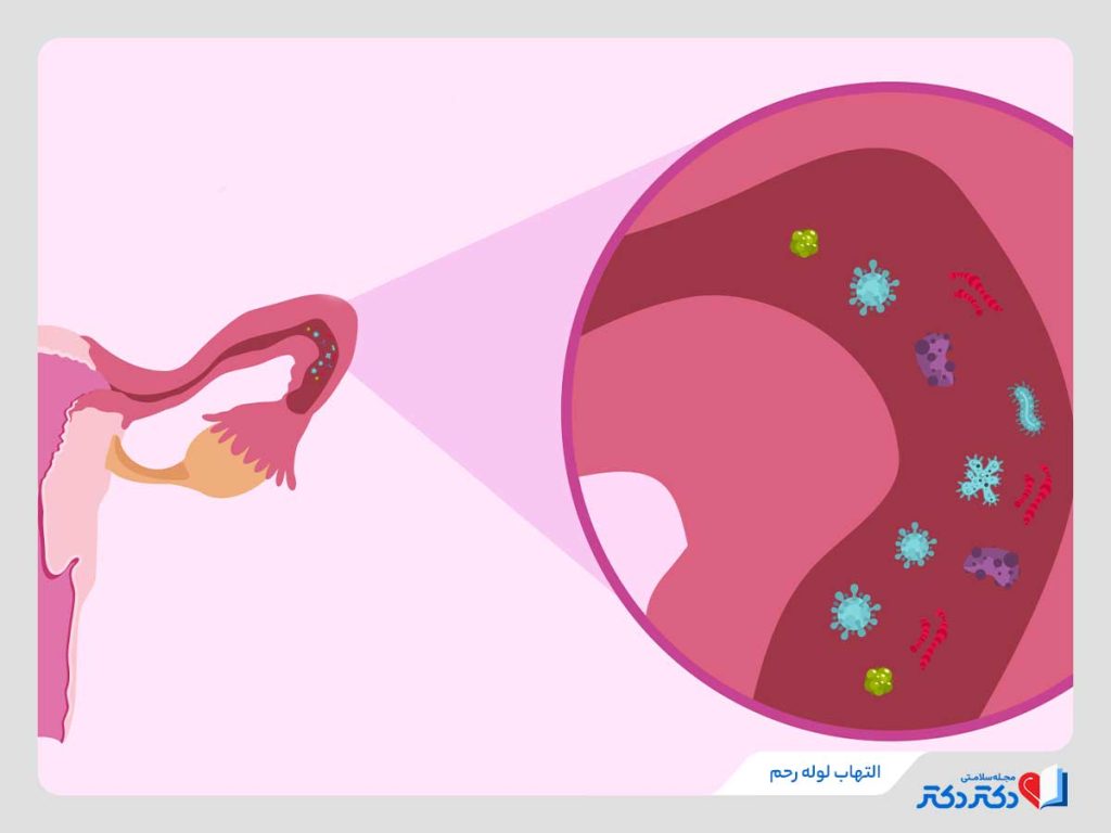 عفونت لوله رحم یا سالپنزیت چیست؟ + علائم، علل، عوارض و درمان